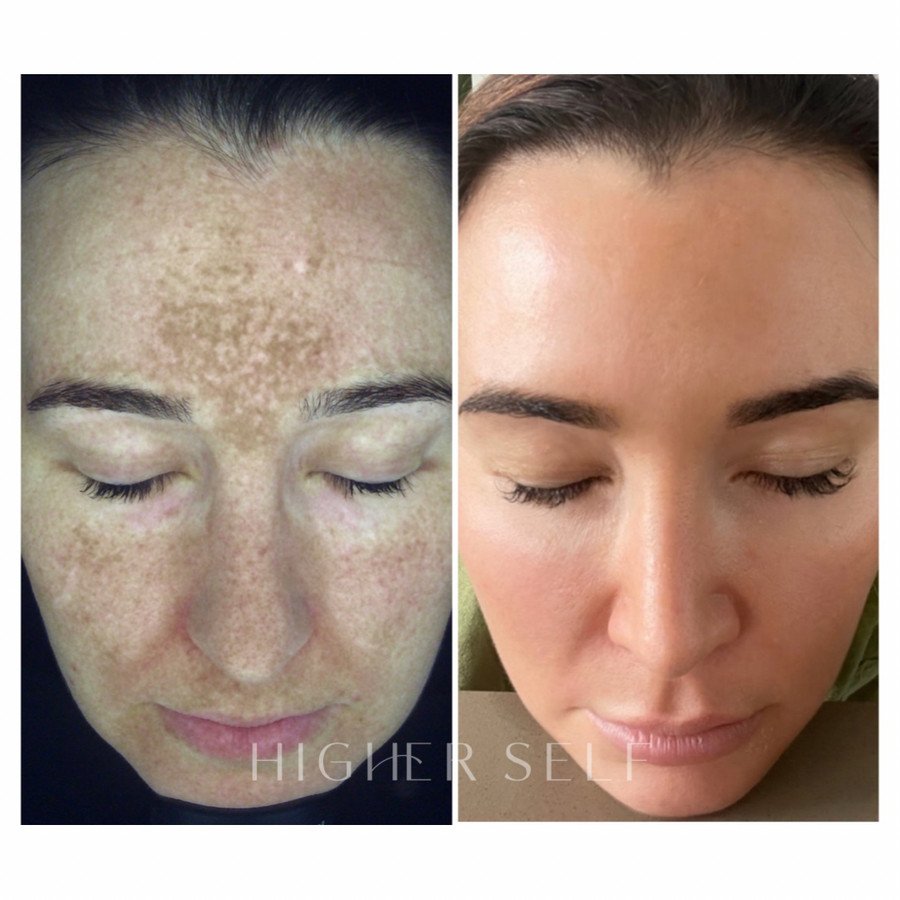 Cosmelan Depigmentation | Higher Self Skin