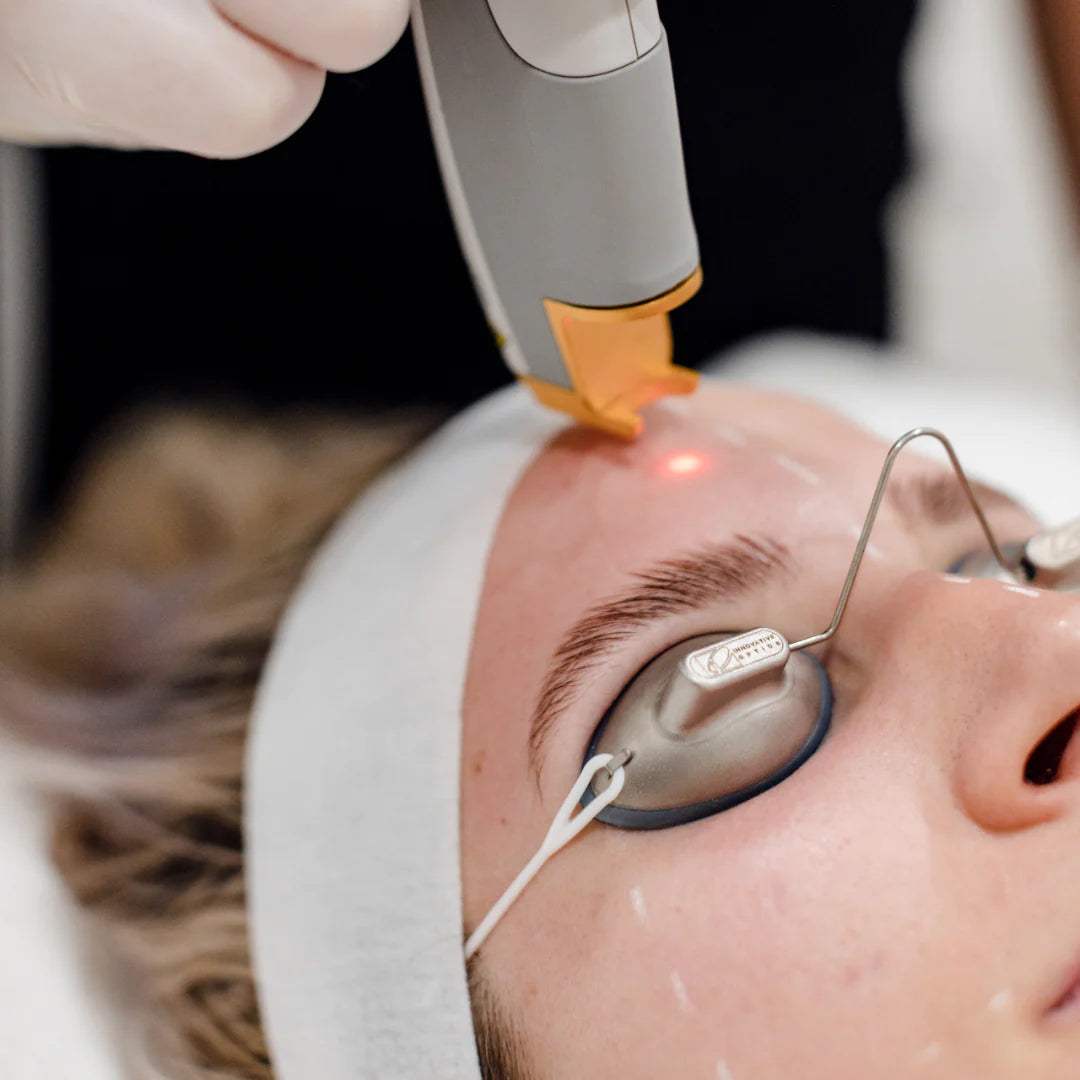 CUTERA LASER GENESIS – Higher Self Skin